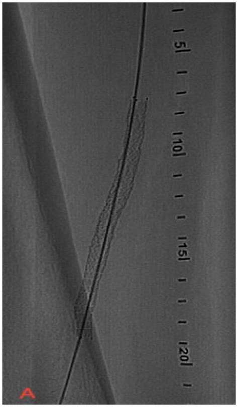 Evaluation Of Safety And Effectiveness Of The Biomimics 3d Stent System