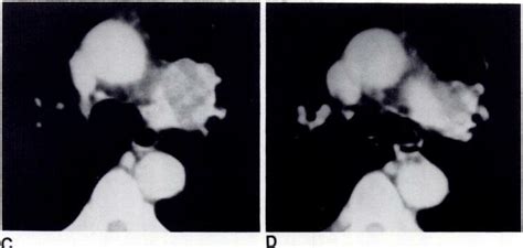 Sequential Ct Scans A D Caudad Through Aortopulmonary Window During