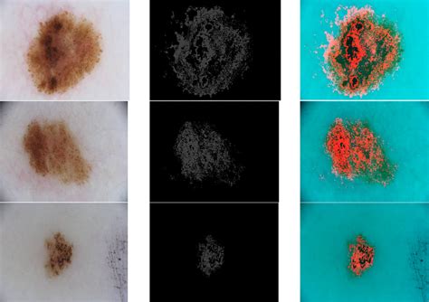 Samples Of The Skin Lesion Area Segmentation A Original Image B Download Scientific