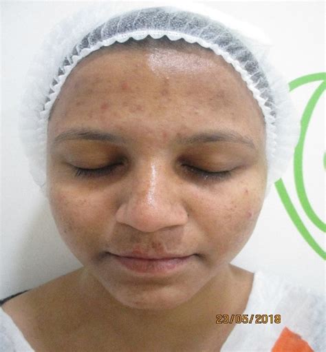 Salicylic Acid Peel Benefits Cost Before And After Results