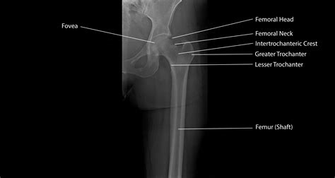 X Ray Femur E Cadaviz