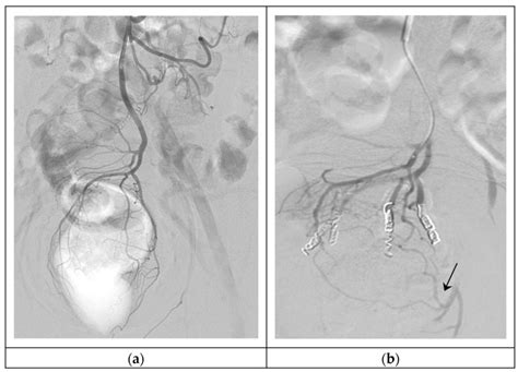 Prevalent Technique And Results Of Hemorrhoidal Embolization Pmc