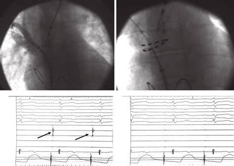 A Case Of Pulmonary Vein Pv Isolation Is Displayed With Use Of The