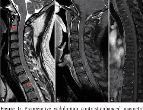 Figure 1 From Spinal Cord Diffuse Midline Glioma With Postoperative Acute Swelling A Case