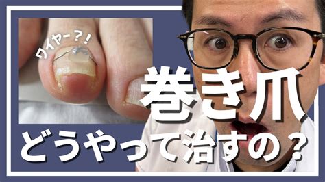 巻き爪矯正技術3tovho どうやって治すの？ Youtube