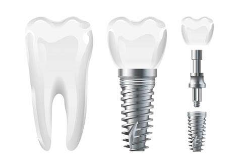 Types Of Dental Implants Which One Is Right For You
