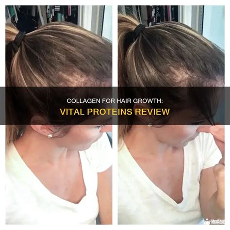 Collagen For Hair Growth Vital Proteins Review Medshun