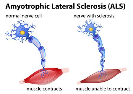 ALS Amyotrophic Lateral Sclerosis Brain Institute OHSU