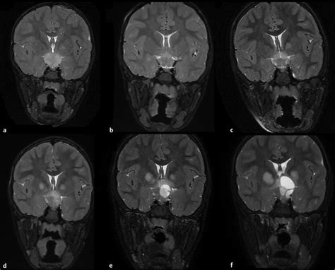 Optic Pathway Gliomas Neupsy Key