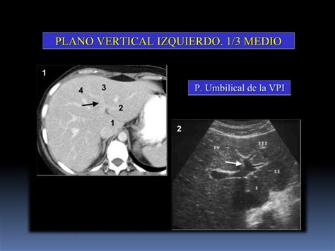 Segmentacion Hepatica Por Imagen Seccional