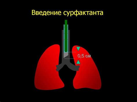 Синдром дыхательных расстройств презентация онлайн