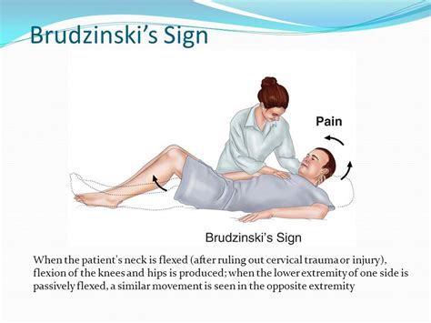Brudzinski Sign