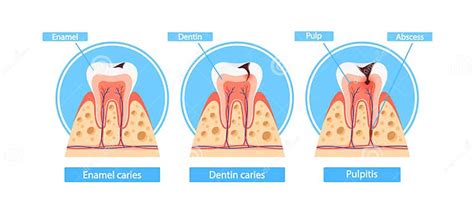 Stages Of Caries Infographics Enamel Caries Dentin Caries And