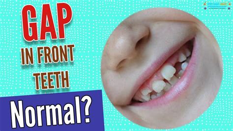 Do All Babies Have A Gap In Their Front Teeth Gap Teeth Teeth
