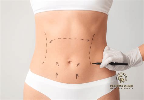عملية شد البطن Platinya Clinic