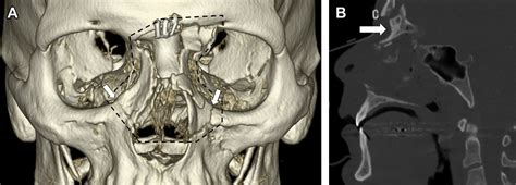 The Imaging Of Maxillofacial Trauma Neuroimaging Clinics