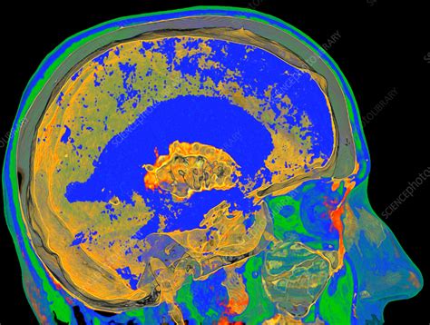 Fahr Syndrome Ct Scan Stock Image C0577912 Science Photo Library