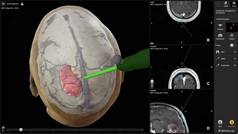 Frontiers Neuronavigation In Glioma Resection Current Applications Challenges And Clinical