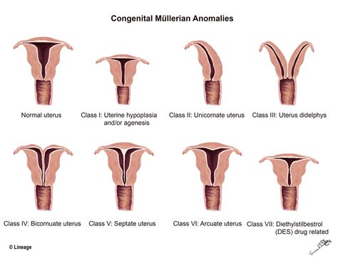 Genital Embryology Embryology Medbullets Step 1