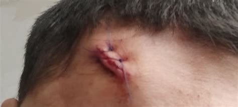 Удаление липомы жировика Medaboutme