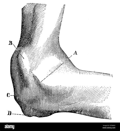Appearance Of The Dislocated Elbow Joint Illustration Of The 19th