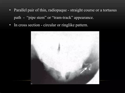 Soft Tissue Calcifications Of The Oral Cavity Pptx