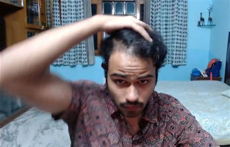 Arpit Is In Stage 3 Of Balding At The Age Of Just 23 Sad R Dankrishu