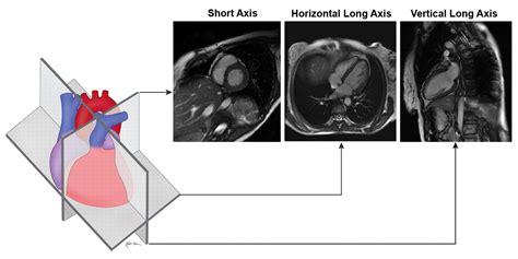 Cardiac Mri Anatomy