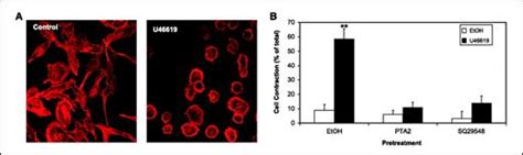 Thromboxane A2 Receptors In Prostate Carcinoma Expression And Its Role