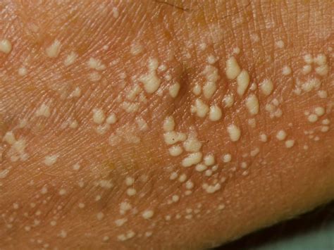 Psoriasis Symptoms Types And Images Verywellhealth