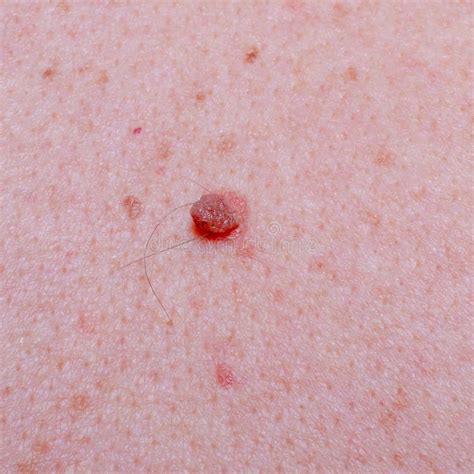 Nevus Or Mole On The Human Body Close Up Skin Cancer Keratosis Or
