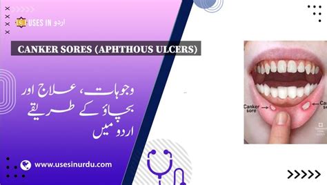 Canker Sores Aphthous Ulcers Uses In Urdu