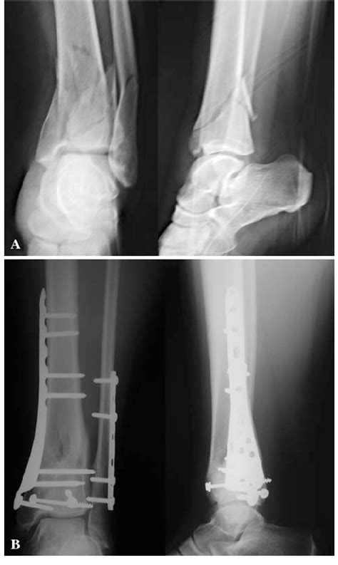 A B A Ao 43 C Fracture And B Plain Radiographs After 1 Year Are