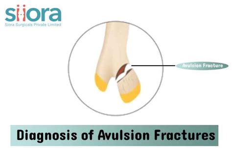 What Are Avulsion Fractures Siora Surgicals Private Limited
