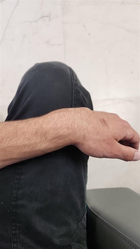 Colles Fracture I Think Unstable Af Waiting For Surgery Plate