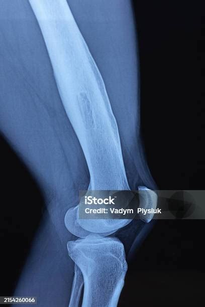 Osteoid Osteoma Benign Bone Tumor Xray And Mri Mrt Ct With Marked