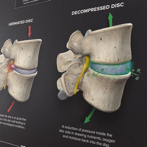 Spinal Decompression Poster Kirografiks