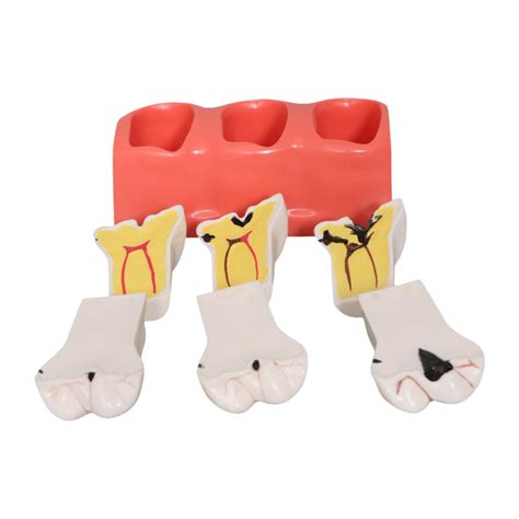 Yotijay Decay Model Caries Model For Classroom Education Props