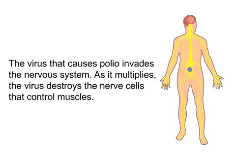 Polio And Post Polio Syndrome