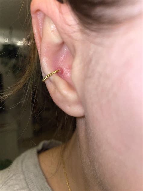 Conch Piercing Bump 7 Months Old R Piercing