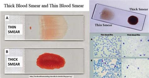 Thick Blood Smear And Thin Blood Smear