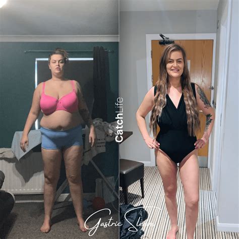 Gastric Sleeve Catchlife Gastric Sleeve Prices In Turkey