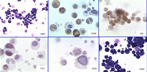 Malignant Cells In Csf