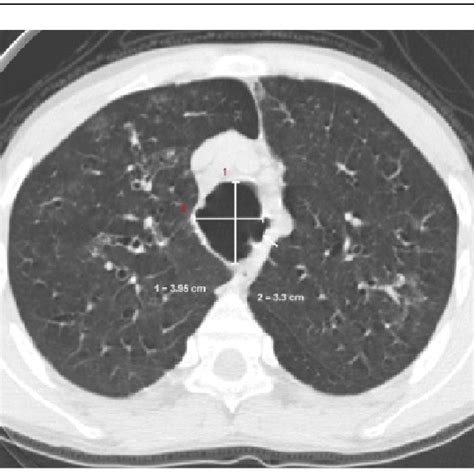Scanogram Of Chest Showing Dilated Trachea And Main Bronchi Download