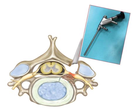 科普｜解惑 神经根型颈椎病”