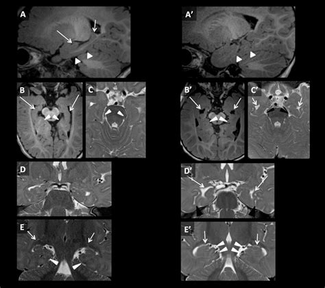 Normal Mri Left And Bilateral Temporal Lobe Dysplasia Right A E