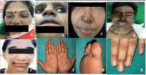 Various Types Of Pigmentation A Facial Pigmentation B Download Scientific Diagram