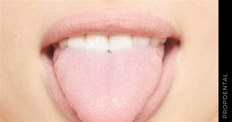 La importancia de una lengua sana Clínicas PropDental