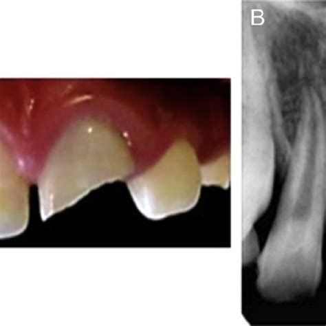 Pdf Apical Closure In Apexification A Review And Case Report Of
