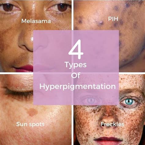 There Are 4 Main Types Of Hyperpigmentation Pih Post Inflammatory Hyperpigmenta